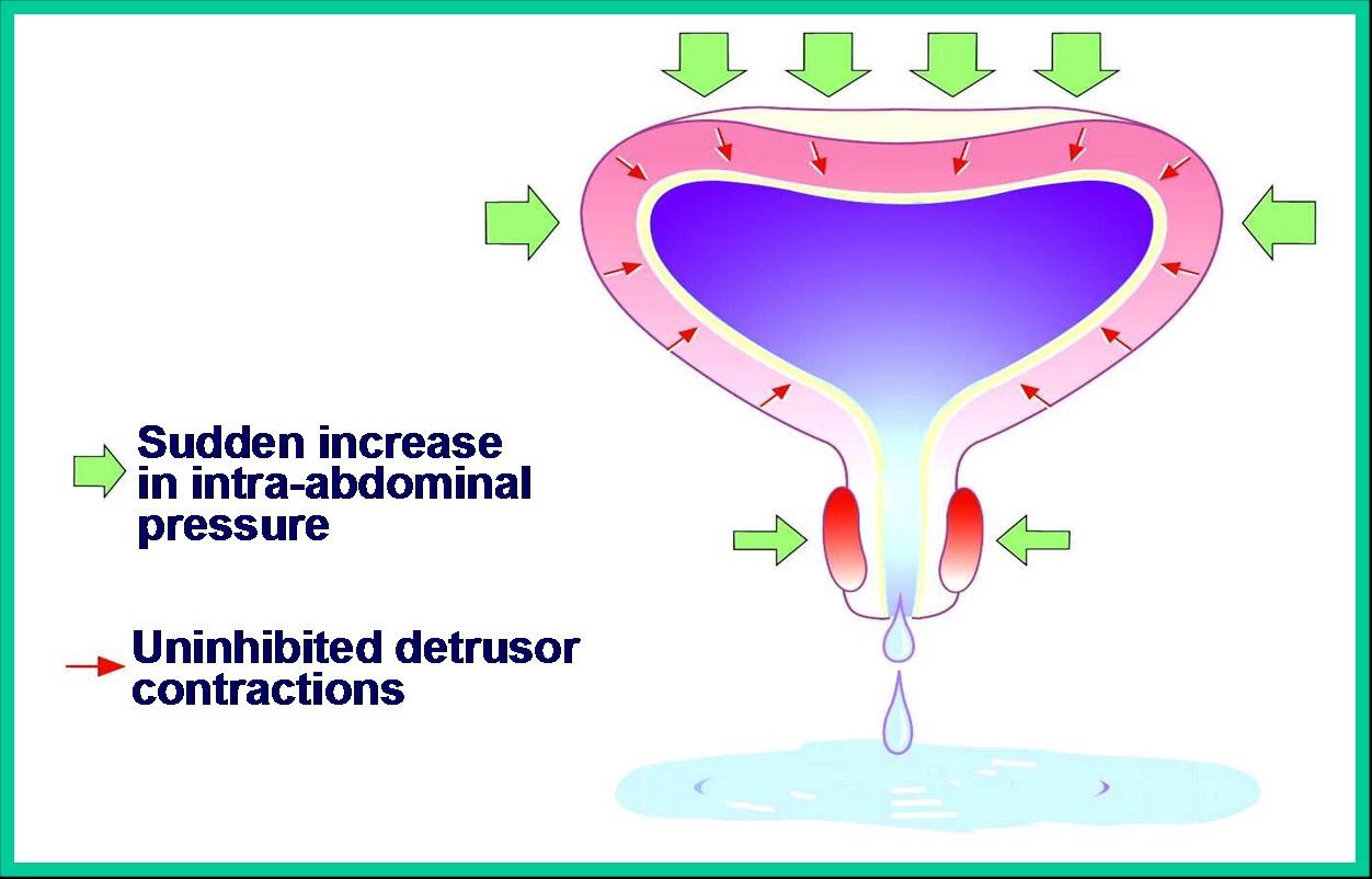 Urinary Incontinence Chin Chong Min Urology Robotic Surgery Centre