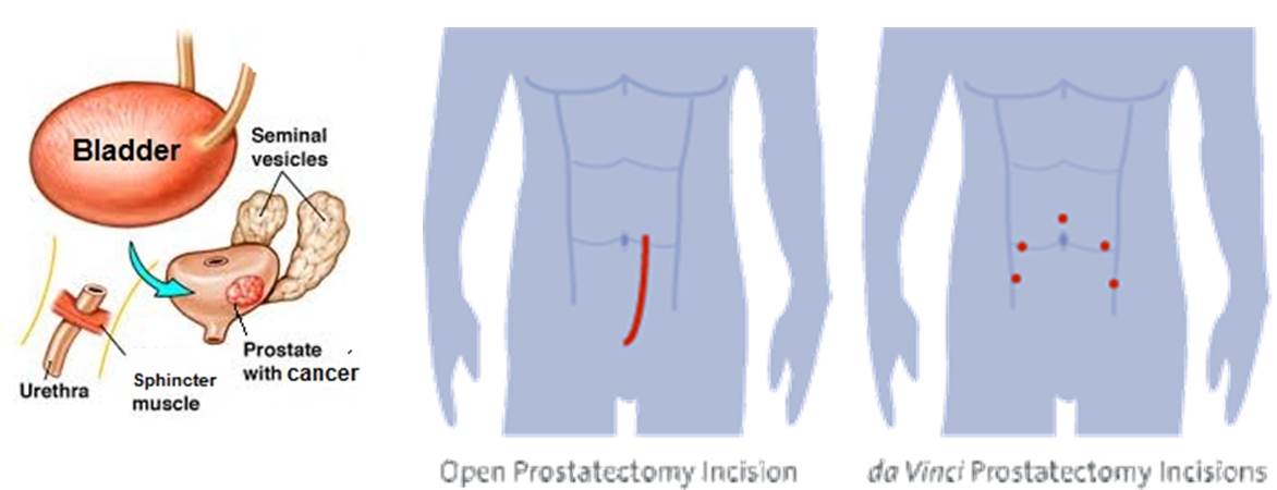 Robotic Radical Prostatectomy - Chin Chong Min Urology