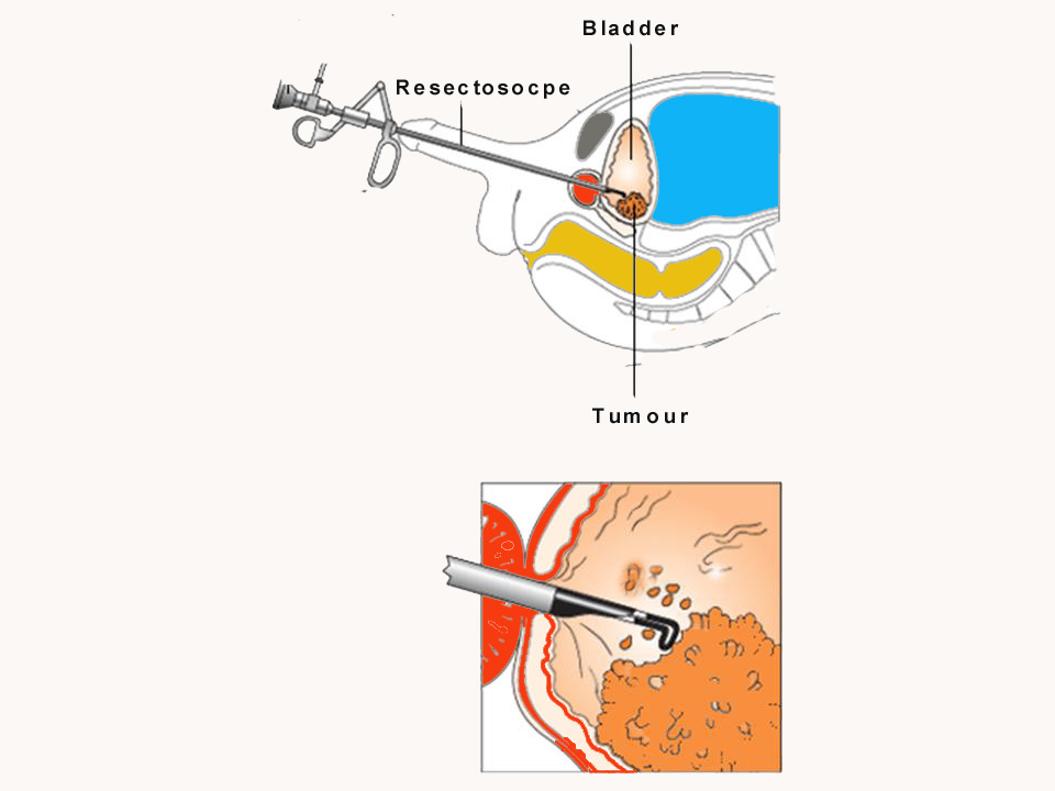Transurethral Resection Of Bladder Tumour TURBT Chin Chong Min