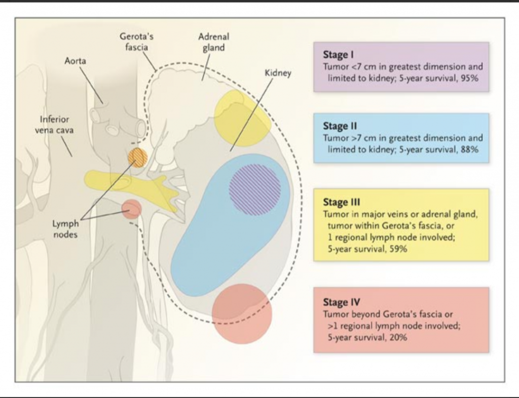 Kidney Cancer - Chin Chong Min Urology & Robotic Surgery Centre