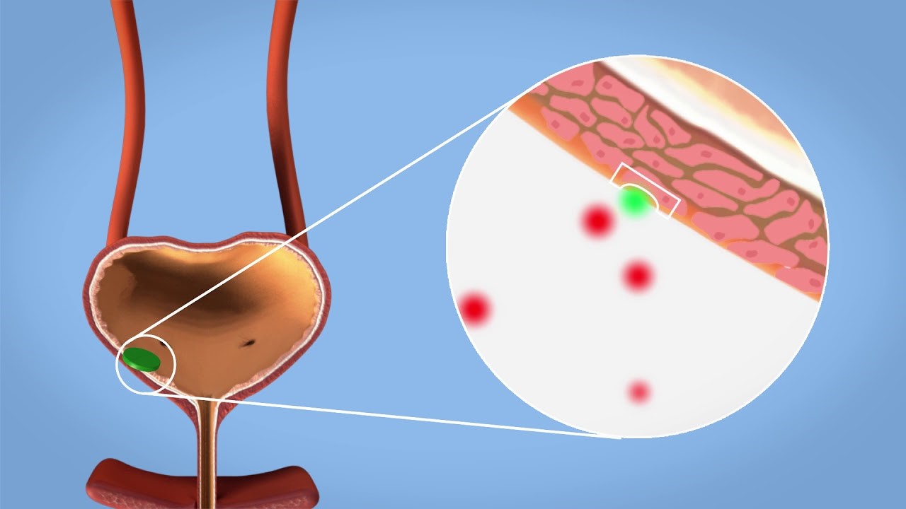 Urinary Incontinence | Chin Chong Min Urology & Robotic Surgery Centre