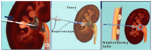 Percutaneous Nephrolithotomy (PCNL) | Chin Chong Min Urology & Robotic ...