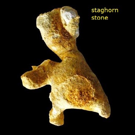 Urinary Stones | Chin Chong Min Urology & Robotic Surgery Centre