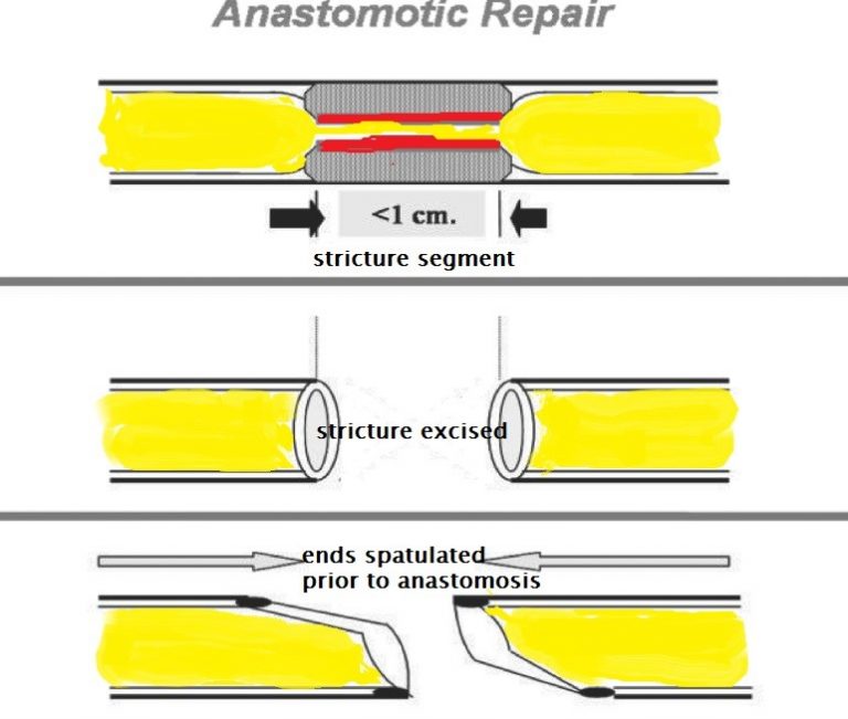 Urethrotomy / Urethroplasty | Chin Chong Min Urology & Robotic Surgery ...