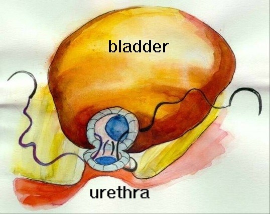 Robotic Prostatectomy | Chin Chong Min Urology & Robotic Surgery Centre