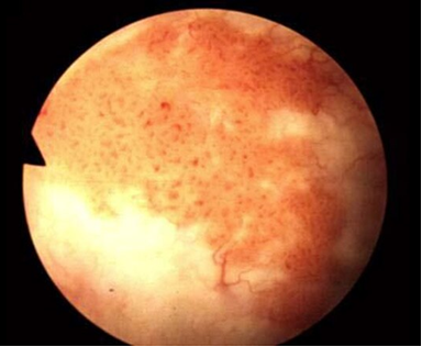 Flexible Cystoscopy | Chin Chong Min Urology & Robotic Surgery Centre