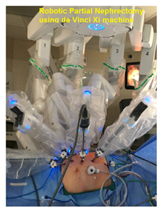Robotic Partial Nephrectomy | Chin Chong Min Urology & Robotic Surgery Centre
