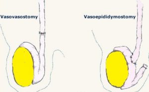 Vasectomy Cks