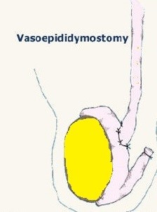 Vasectomy Reversal | Chin Chong Min Urology & Robotic Surgery Centre