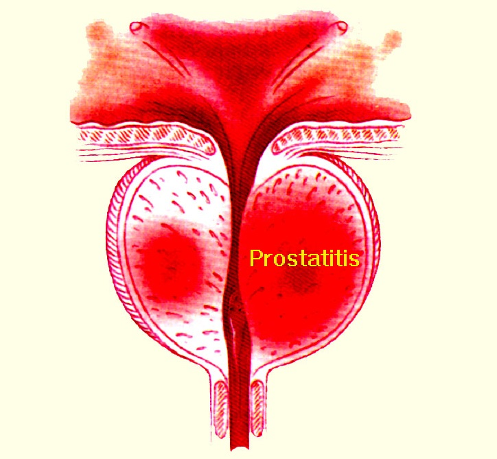 Microhaematuria | Chin Chong Min Urology & Robotic Surgery Centre