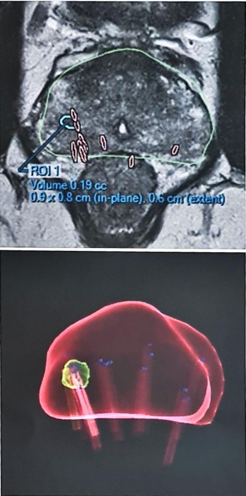 Prostate Biopsy Trus Or Mri Us Fusion Method Chin Chong Min Urology