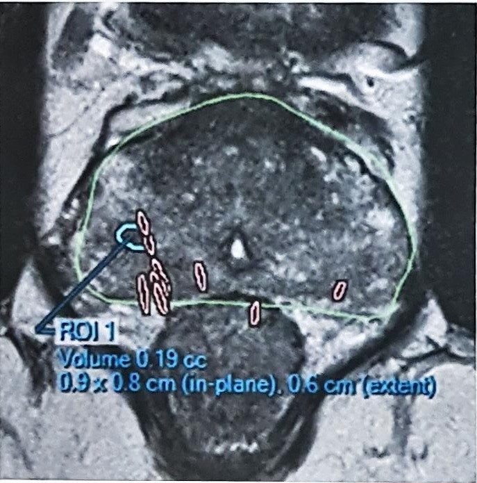 Prostate Biopsy Trus Or Mri Us Fusion Method Chin Chong Min Urology
